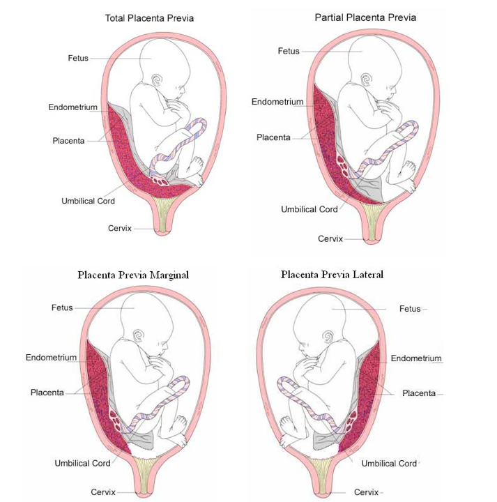 Placenta Baja Sin Sangrado Actualizado Abril 2024 Placenta Baja Sin Sangrado Actualizado Abril 2024